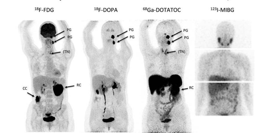 Multiple Neoplasms Simultaneously Diagnosed by Complementary Triple ...